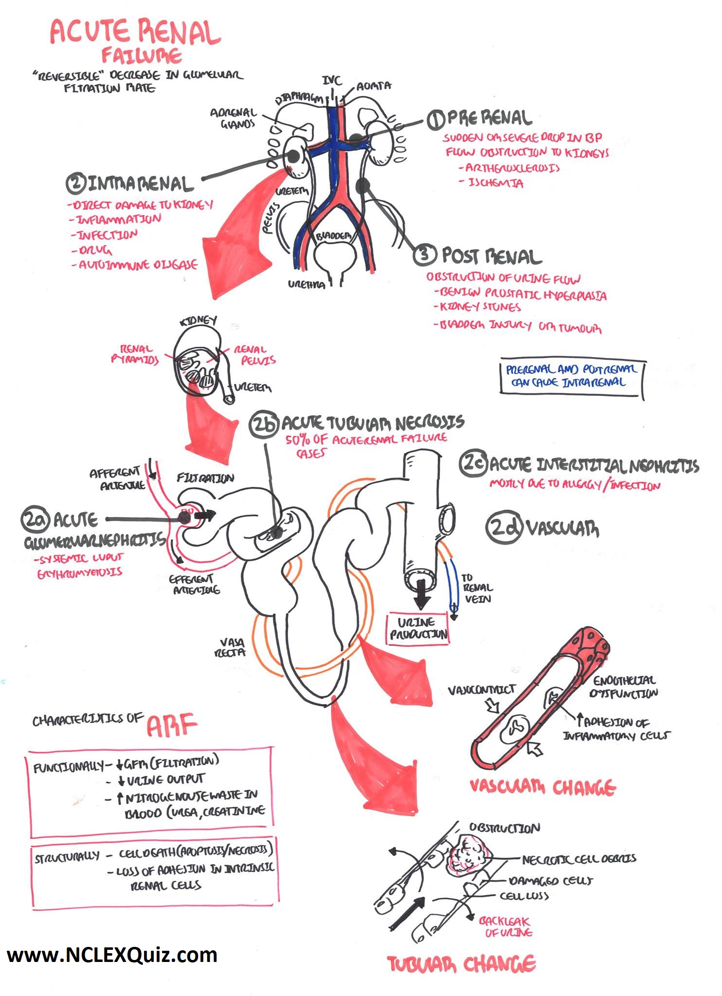 Pathophysiology Acute Renal Failure For Nursing Students NCLEX Quiz