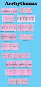 Cardiac Dysrhythmia (also Known As Arrhythmia & Irregular Heartbeat ...