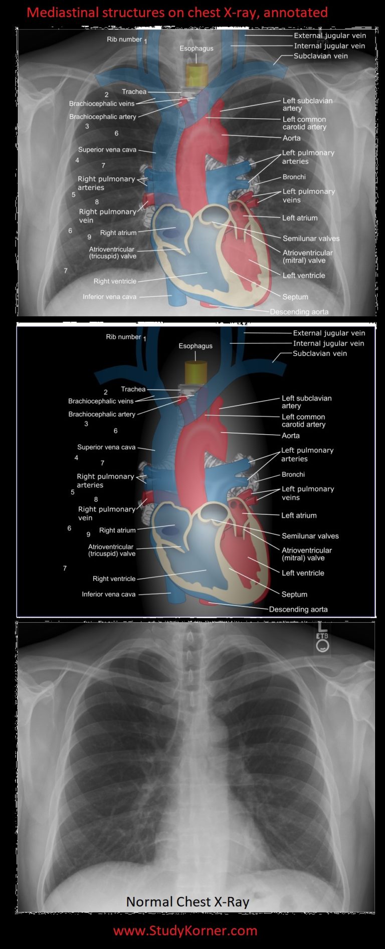 Mediastinal structures on a chest X-ray, annotated - NCLEX Quiz