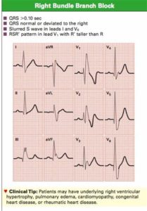 Right Bundle Branch Block (RBBB) Ecg Criteria - NCLEX Quiz