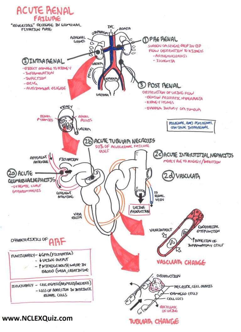 Pathophysiology Acute Renal Failure for Nursing Students - NCLEX Quiz