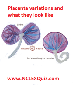 Placenta variations: Bilobed & Battledore - NCLEX Quiz