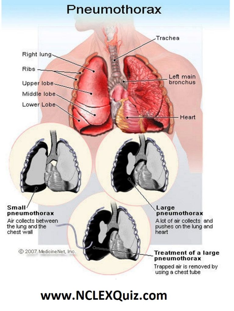 Nursing Notes: Difference between Atelectasis and Pneumothorax - NCLEX Quiz