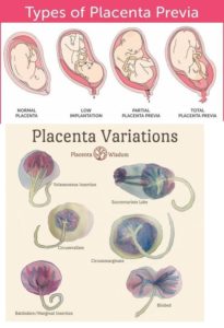 Placenta variations and what they look like - NCLEX Quiz