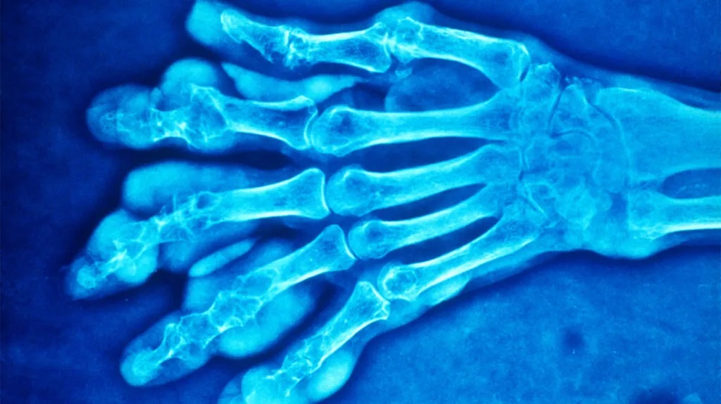 NCLEX Practice Quiz on Allopurinol and Client Concerns in Gout - NCLEX Quiz