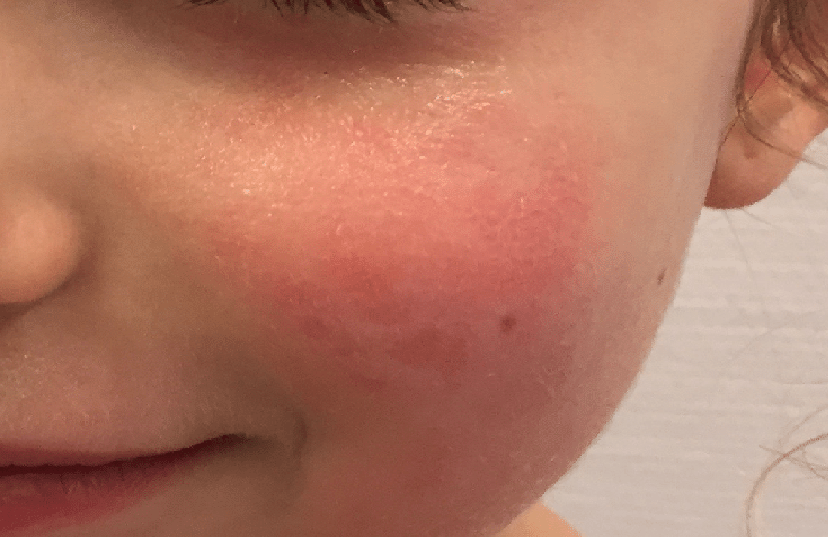 Critical Assessment Priorities in Thermal Burn from Steam Inhalation ...